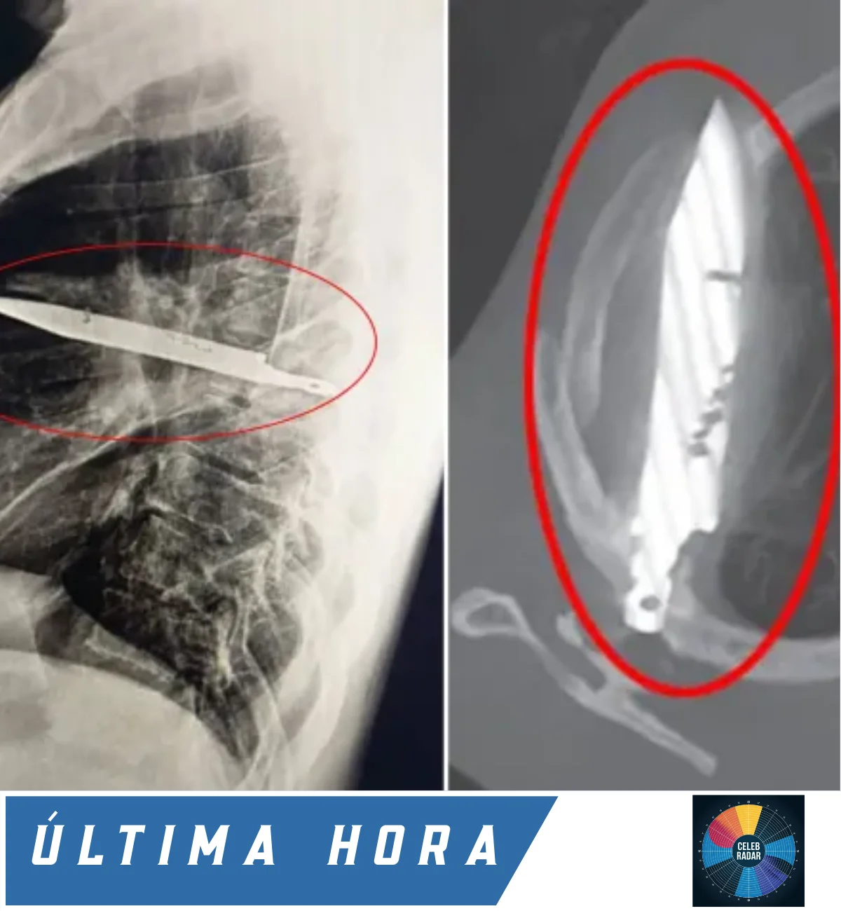 Un hombre se queja de dolor en un pezón y los médicos descubren que ...